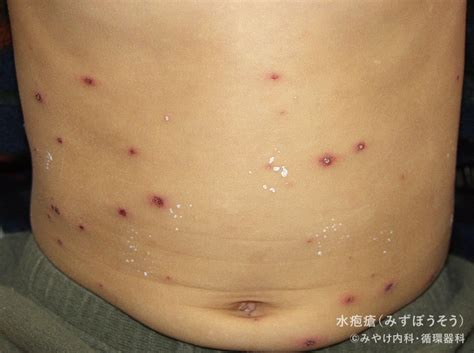水疱瘡水痘｜写真で見る「子どもの病気」 みやけ内科・循環器科