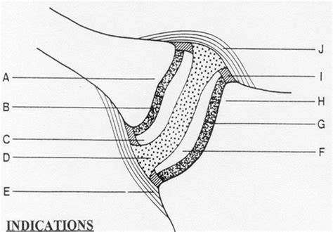 Sc Joint Anatomy And Clinical Indications Flashcards Quizlet