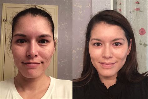 Can You Use Tretinoin On Lips