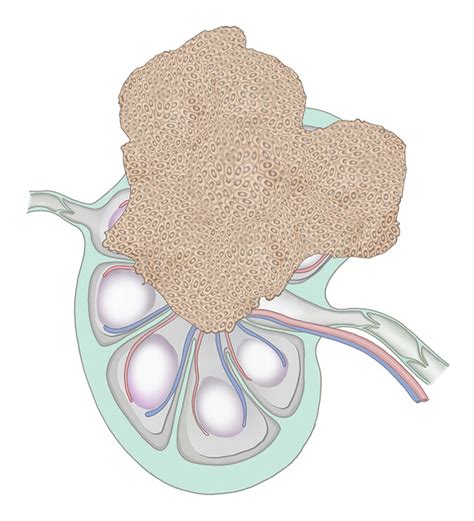 Radiologic Extranodal Extension Of Metastatic Lymph Nodes In Patients With Non Small Cell Lung