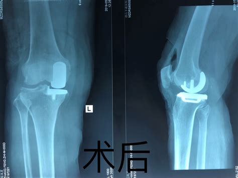 丰南区医院骨一科完成我院首例膝关节单髁置换手术 唐山丰南区医院
