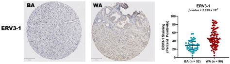 Prostate Cancer Molecular Feature With Prognostic Value Distinguishes