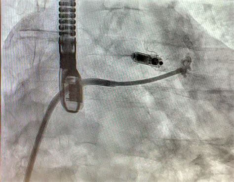 Watchman Abbott Amplatzer Micra Leadless Pacemaker Afib Arrhythmia Bostonscientific