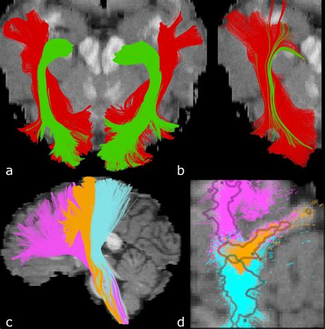 Erroneous Bundle Segmentation Examples A Ilf Red And Or Green