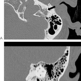 A Axial And B Coronal Computed Tomographic Scans In Bone