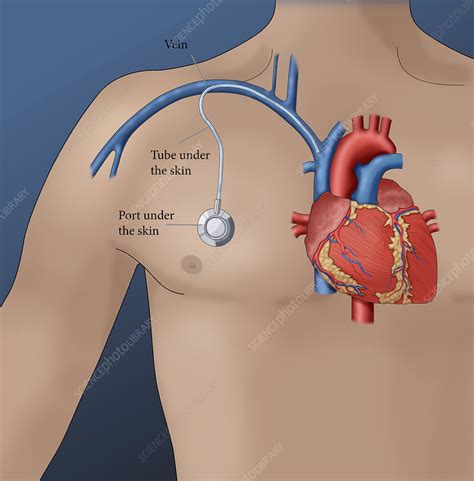 Venous Access Port Illustration Stock Image C Science Photo Library