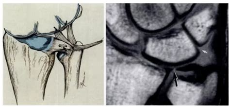 Tfcc损伤的诊断及关节镜治疗 骨科在线