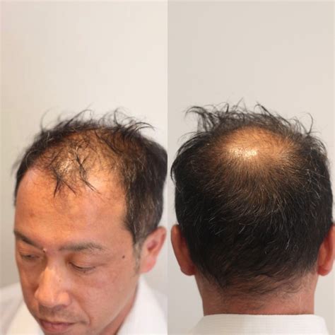 頭頂部 髪型薄毛軟毛もカバーするカットとセットのポイント INTI report 薄毛に悩む男性の為の美容院INTI インティ 全席個室東京大阪福岡に展開