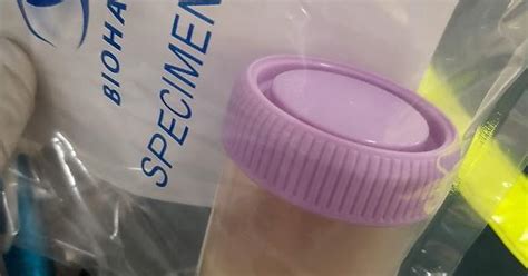 Pyuria Urine Sample Album On Imgur