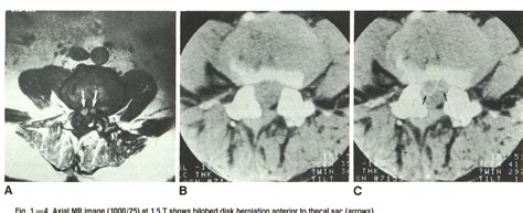 Figure 1 From Differentiation Between Postoperative Scar And Recurrent