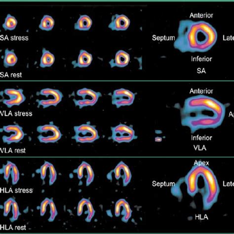 Myocardial Perfusion Visual Analysis By Spect 16 Download Scientific Diagram