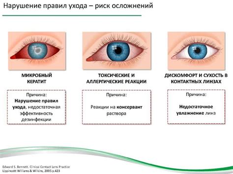 Сухой глаз. симптомы синдрома сухого глаза. причины сухости в глазах ...
