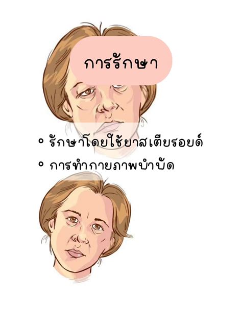 หน้าเบี้ยว ครึ่งซีก ใครนอนน้อยต้องระวัง‼️ แกลเลอรีที่โพสต์โดย