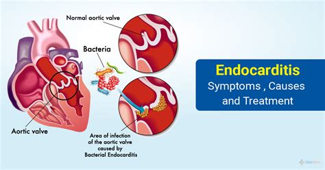 Infective Endocarditis Causes Signs Symptoms Infective Endocarditis