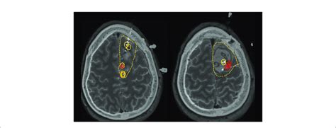 Circles Represent Active Interictal Epileptiform Discharges The Download Scientific Diagram
