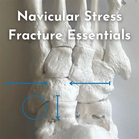 Navicular Stress Fracture Essentials Nathan Carlson Running Mate