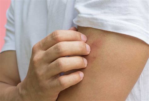 What Happens If Humans Get Flea Bites Patchpuppy Com