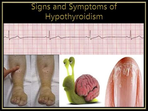 Review Of Thyroid Dysfunction Ppt