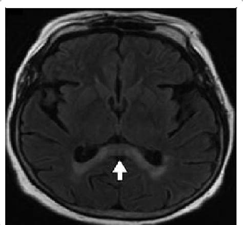 Axial Flair Mri Showing Demyelinating Lesion In Anterior And Posterior