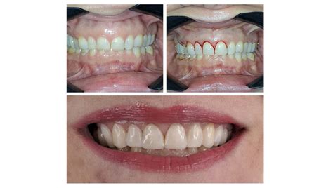 Gingivectomy And Gingivoplasty In Treatment Or Aesthetic Cases