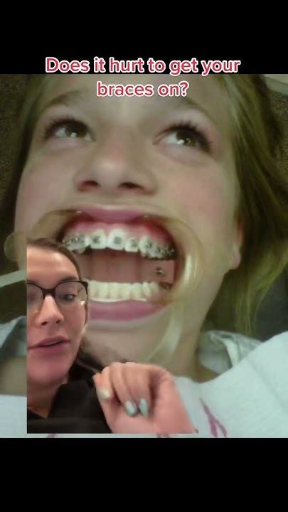 Braces Youtube