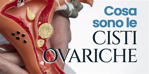 Cosa Sono Le Cisti Ovariche Blog Poliambulatoriopanaceait