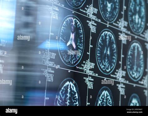 Scientist Viewing A Patients Brain Mri Magnetic Resonance Imaging