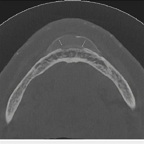The Axial View Of The Cone Beam Computed Tomography Cbct Showing The