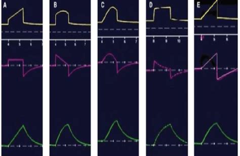 Typical Flow Waveforms Used By Different Modes Of Ventilators Upper