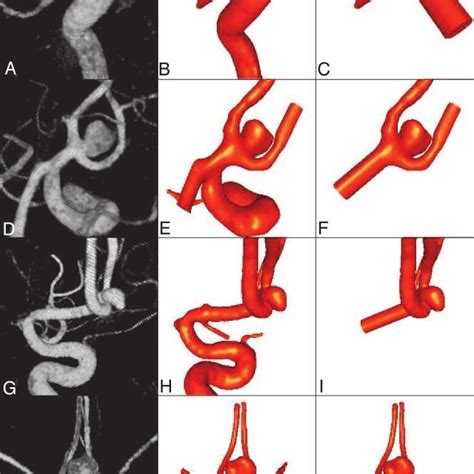 Pdf Computational Fluid Dynamics Modeling Of Intracranial Aneurysms