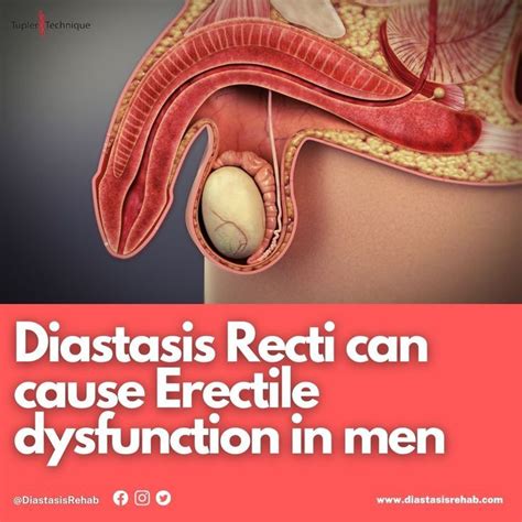 Diastasis Recti Can Cause Erectile Dysfunction In Men Artofit