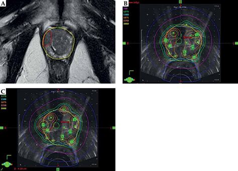 Dose Differentiated High Dose Rate Prostate Brachytherapy A