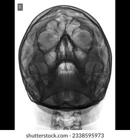 1 868 Nose X Ray Images Stock Photos 3D Objects Vectors Shutterstock