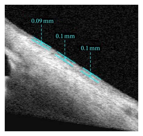 Imaging Of As Oct Shows Measurement Of Thickness Of The Conjunctival