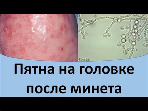 Пятна на половом члене причины и лечение