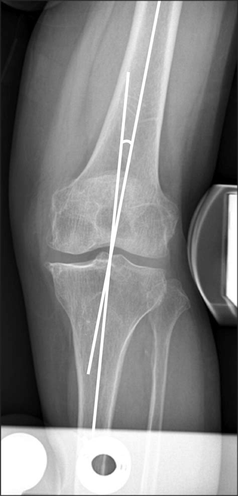 Measurement Of Preoperative Valgus Stress Angle Vsa On A Valgus