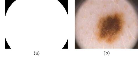 Figure 1 From Comparison Of Segmentation Methods For Melanoma Diagnosis