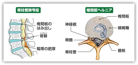 手足や首、肩のしびれ、放っておくと危険！ 原因は？大きな病気が潜んでいる可能性も│ヘルス×ライフweb～あなたと健康を考えるサイト～