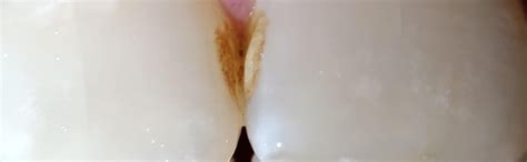 Is This Staining Between My Upper Front Teeth And Or Caries I Drink Coffee Wine Beer And