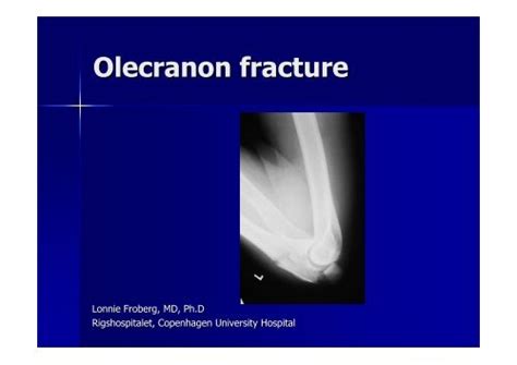 Olecranon Elbow Olecranon Bursitis South Florida Hand Center