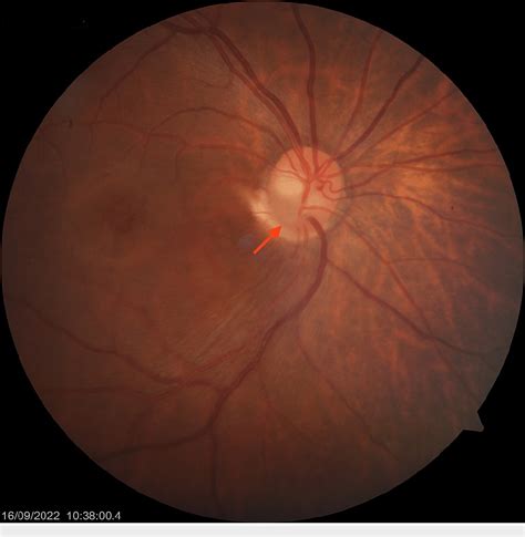 Figure 1 From A Classical Presentation Of Optic Disc Pits With Complex Maculopathy Semantic
