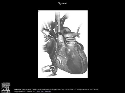 Repair Of Anomalous Coronary Artery From The Pulmonary Artery By Aortic