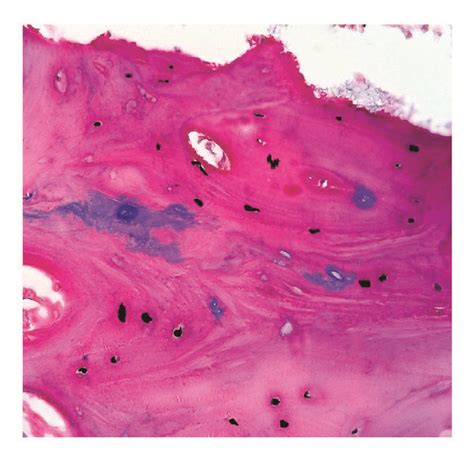 Normal Bone With Active Osteoblasts Producing Osteoid Matrix In The