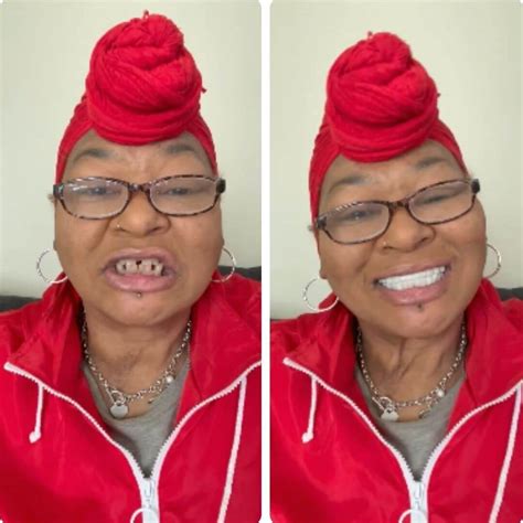 What Are Spare Veneers That Are Rewarded Pop On Veneers