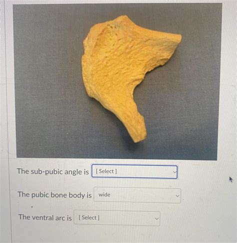 The Subpubic Angle Is Wide Or Narrowthe Pubic Bone