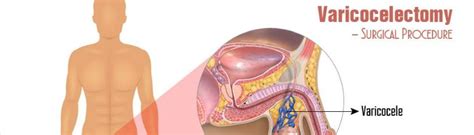Ilioinguinal Iliohypogsstric Nerve Block Vs General Anesthesia In