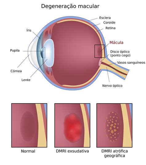 Degeneração Macular Tipos Causas Tratamento Infoescola