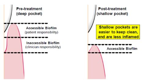 Perio Periodontal Treatment Outcome Flashcards Quizlet