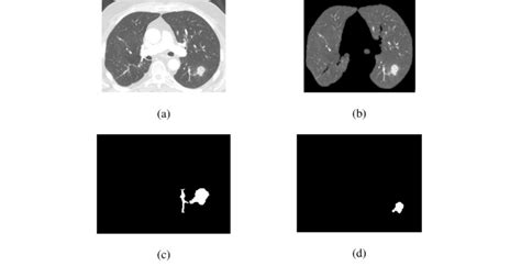 An Example For Solid Nodule Image Taken From Lidc Idri A Input Download Scientific Diagram