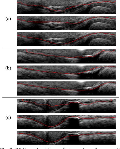 Figure 2 From Automatic Ivus Media Adventitia Border Extraction Using Double Interface Graph Cut